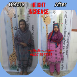 Grow Taller by Height Increase Surgery – Pakistan Orthopaedic ...